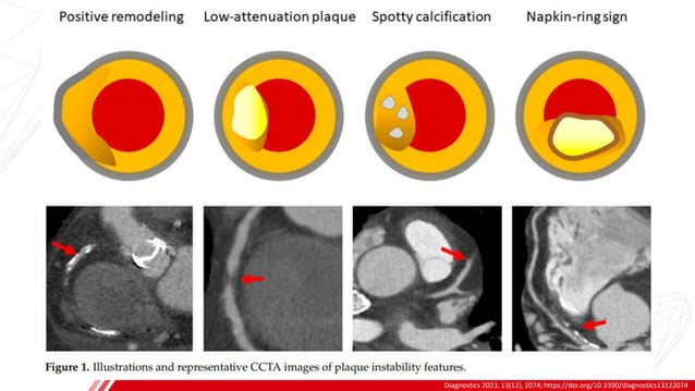 CALCIUM MODIFICATION TECHNIQUES IN COMPLEX PCI | PDF | Heart and ...
