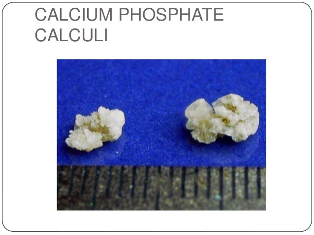 Calcium phosphate calculi