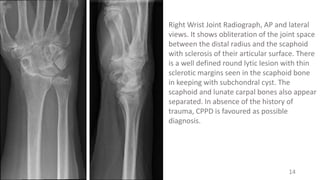 Calcium Pyrophosphate Dihydrate Deposition Disease.pptx