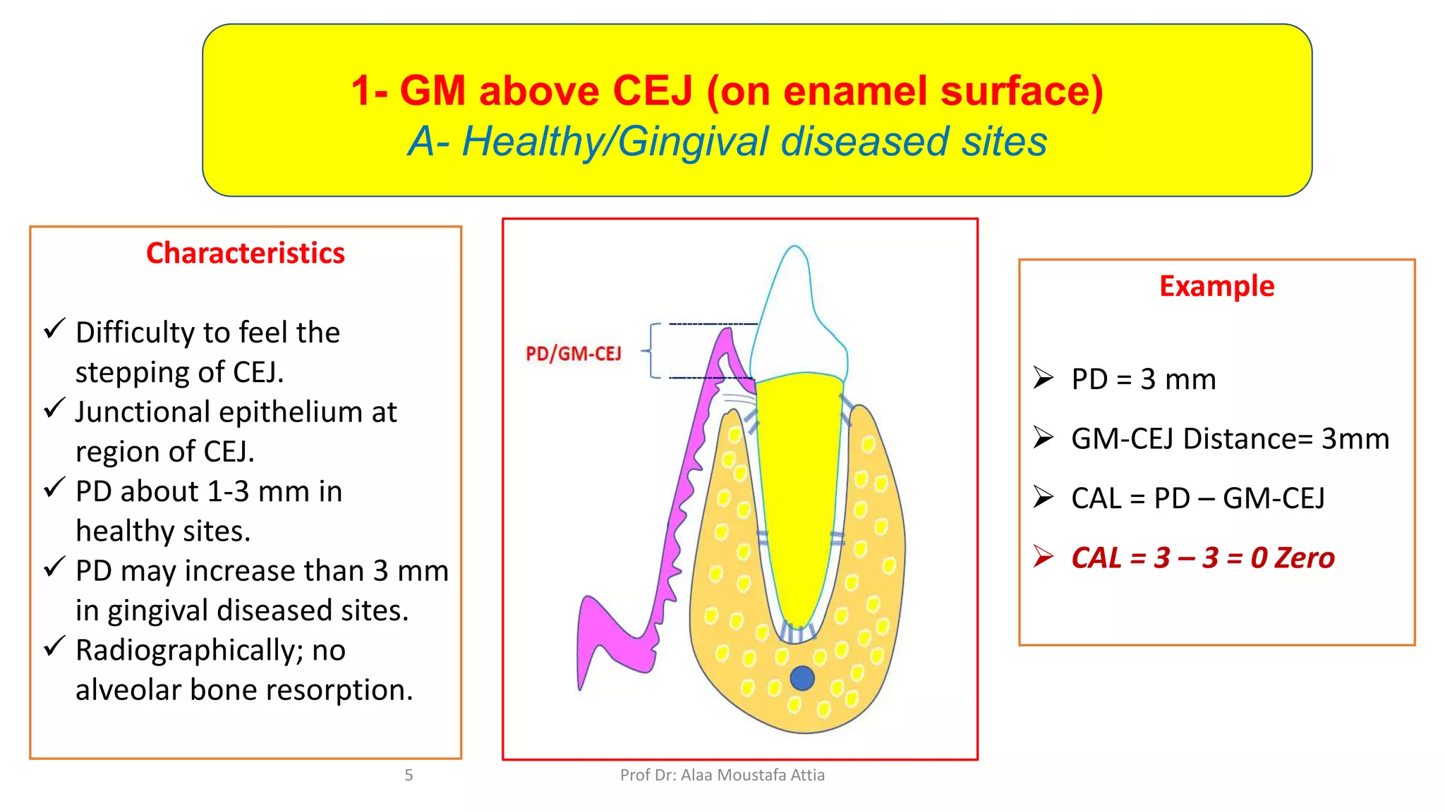 Calculation of clinical attachment level (cal), Prof Dr: Alaa Moustafa ...