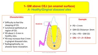 Calculation of clinical attachment level (cal), Prof Dr: Alaa Moustafa ...
