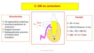 Calculation of clinical attachment level (cal), Prof Dr: Alaa Moustafa ...