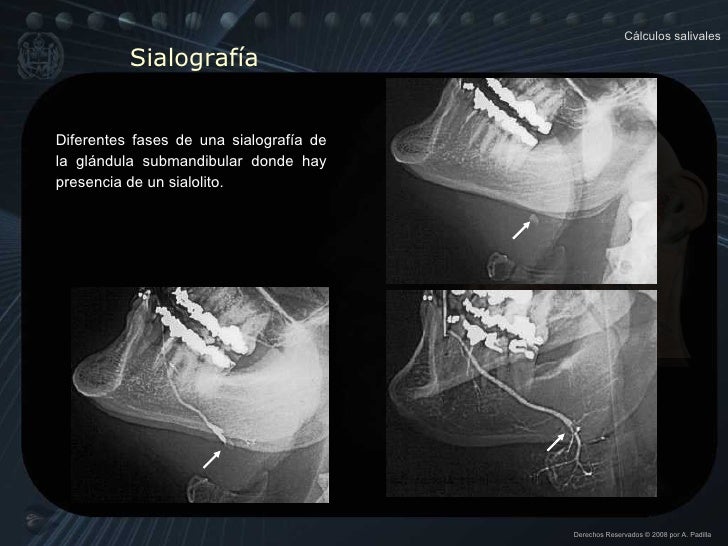 ESTUDIO RADIOGRÁFICO DE LOS CALCULOS SALIVALES. SIALOGRAFÍA
