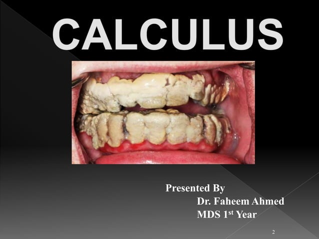 Calculus (Classification, composition, microbiology etc.pptx
