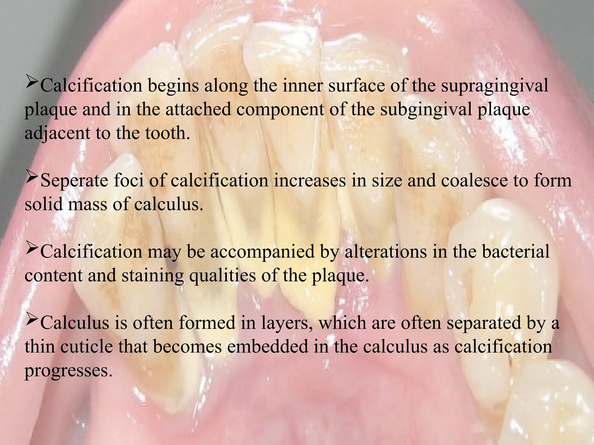 Calculus- Calcification of the plaque maturation | PPT