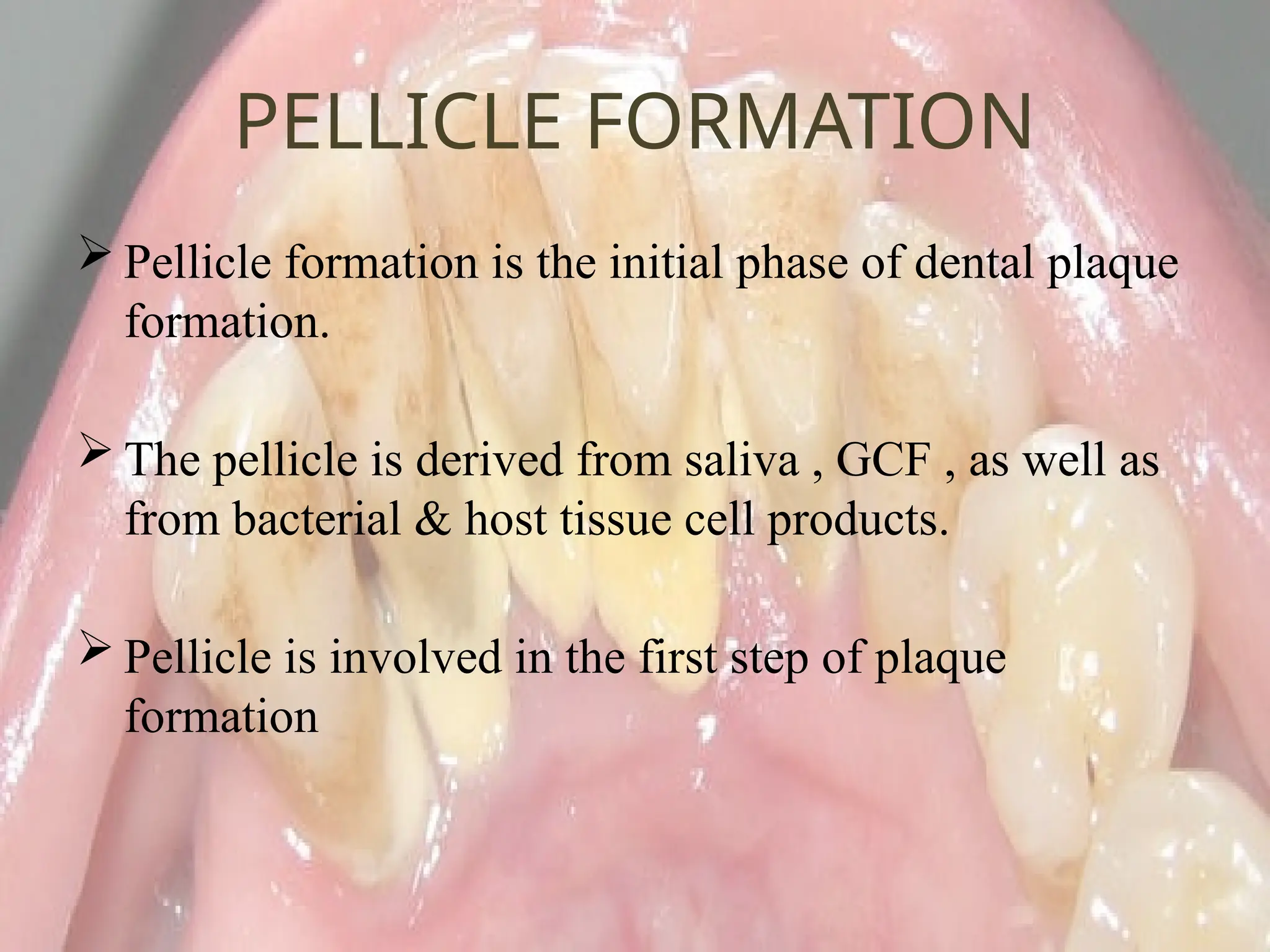 Calculus- Calcification of the plaque maturation | PPT
