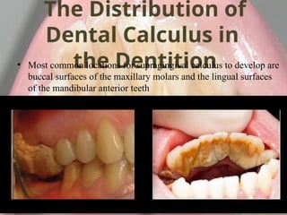 Calculus- Calcification of the plaque maturation | PPTX
