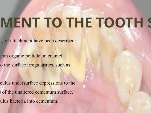 Calculus- Calcification of the plaque maturation | PPT