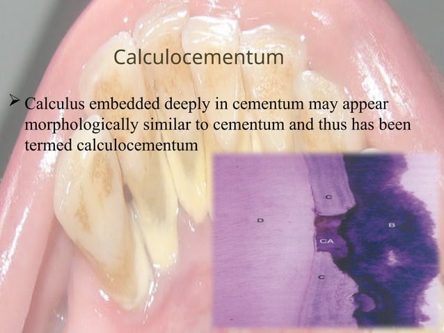 Calculus- Calcification of the plaque maturation | PPT