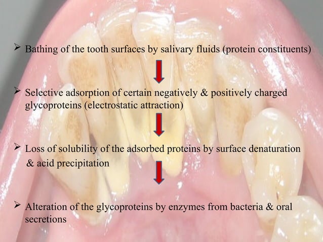 Calculus- Calcification of the plaque maturation | PPT
