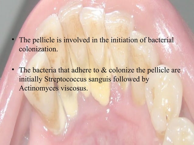 Calculus- Calcification of the plaque maturation | PPT