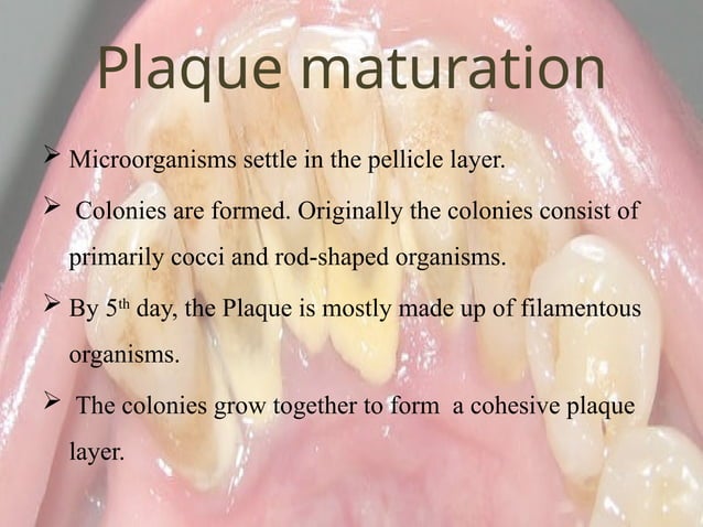 Calculus- Calcification of the plaque maturation | PPT