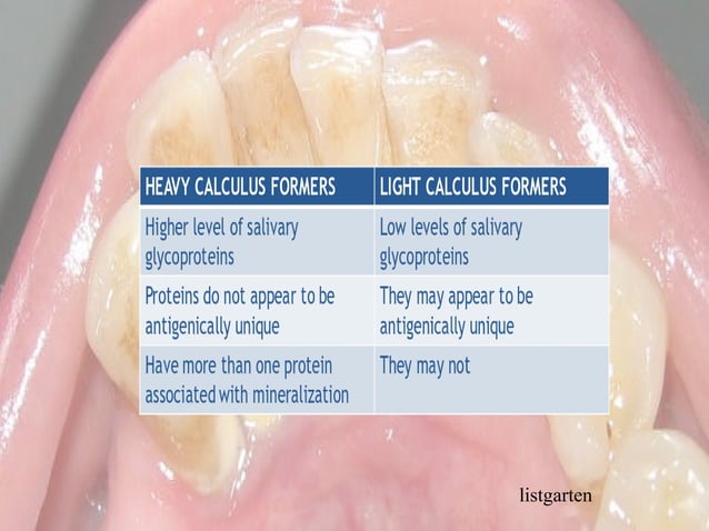Calculus- Calcification of the plaque maturation | PPT