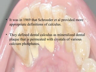 Calculus- Calcification of the plaque maturation | PPTX