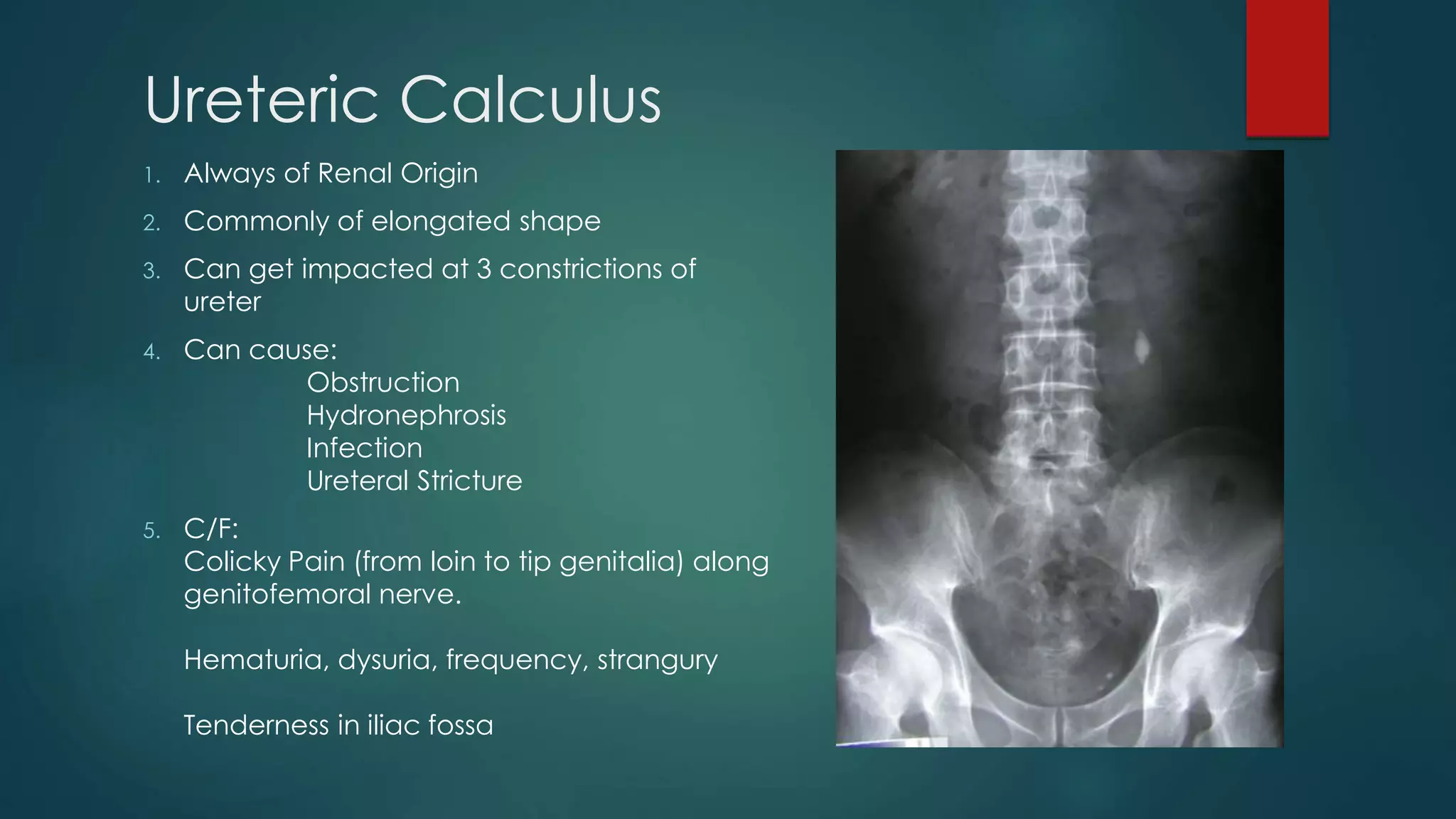 Calculus Disease Renal Stones Radiology | PPTX