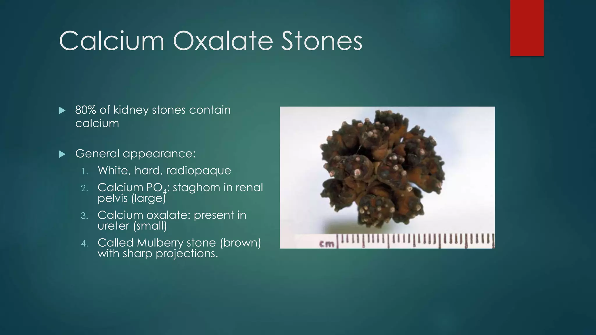 Calculus Disease Renal Stones Radiology | PPT