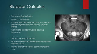 Calculus Disease Renal Stones Radiology | PPTX