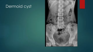 Calculus Disease Renal Stones Radiology | PPTX