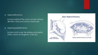 Calculus Disease Renal Stones Radiology | PPTX