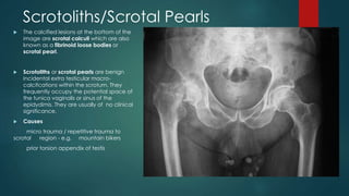 Calculus Disease Renal Stones Radiology | PPT