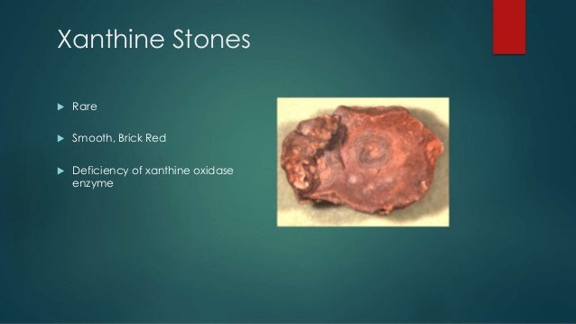 Calculus Disease Renal Stones Radiology
