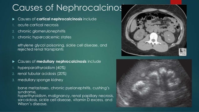 Calculus Disease Renal Stones Radiology