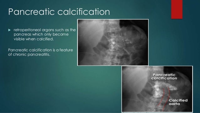 Types Of Kidney Calcifications