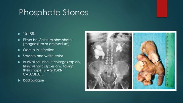 Calculus Disease Renal Stones Radiology