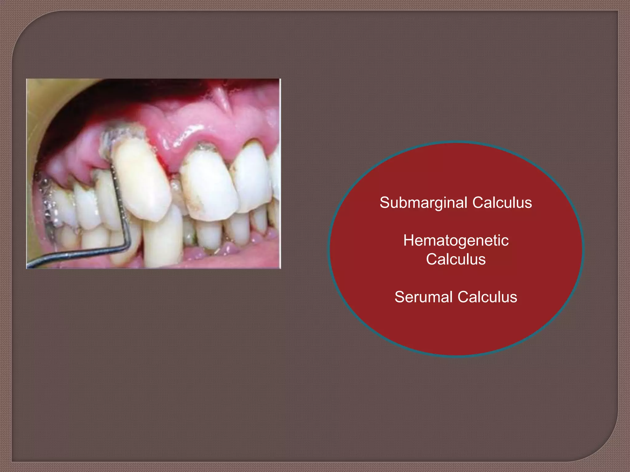 Dental Calculus ppt | PPTX