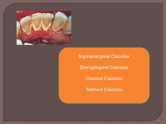 Dental Calculus ppt | PPTX