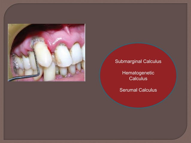 Dental Calculus ppt | PPTX