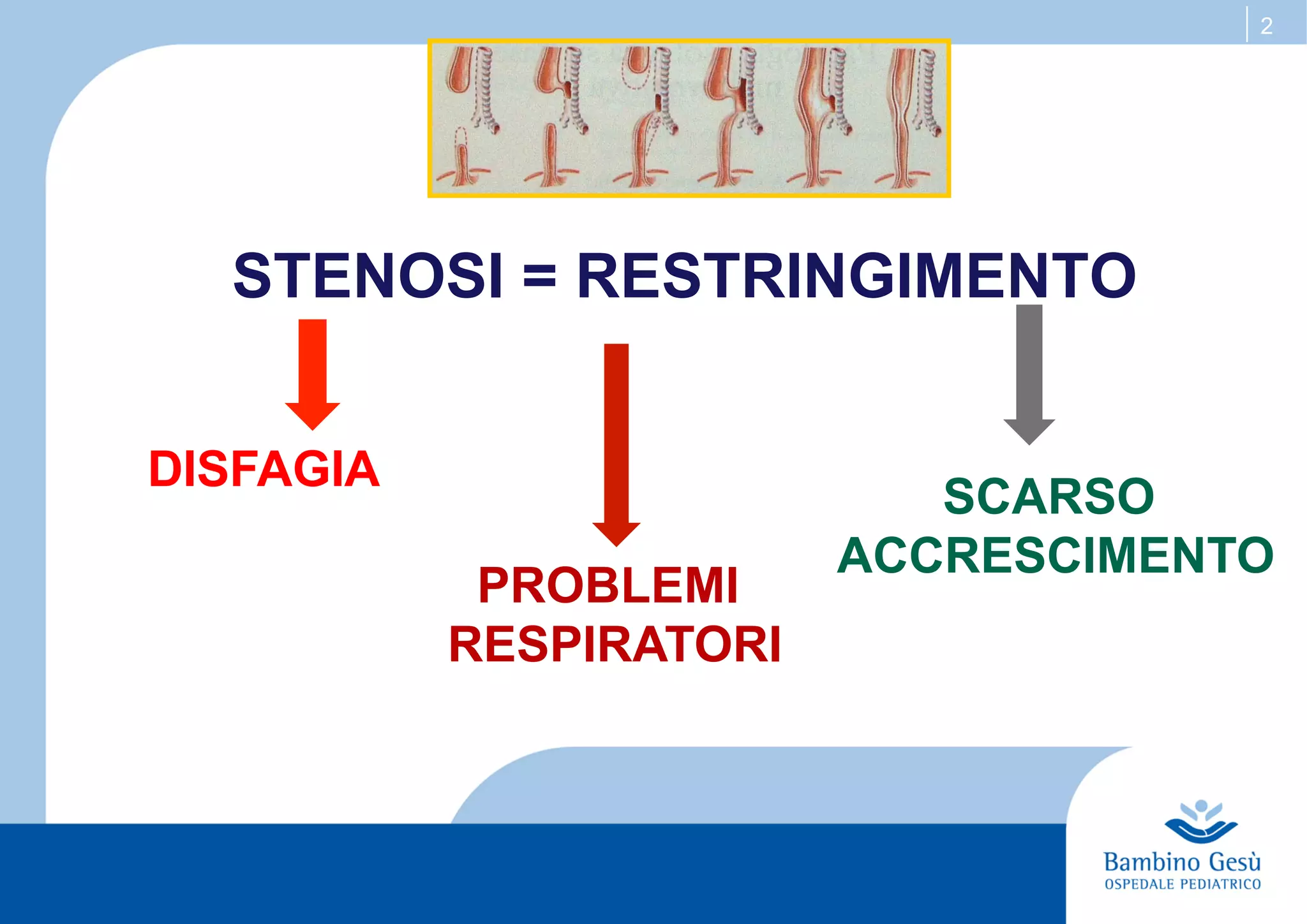 Atresia Esofagea - Stenosi e MRGE | PDF