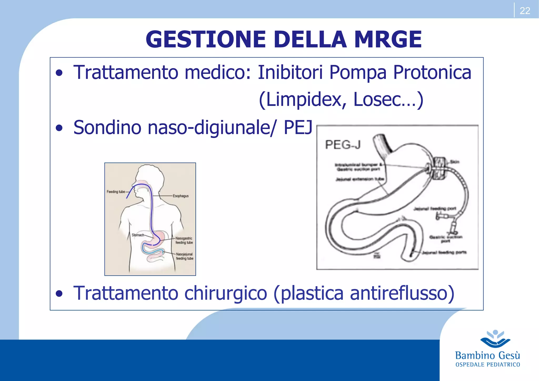 Atresia Esofagea - Stenosi e MRGE | PDF