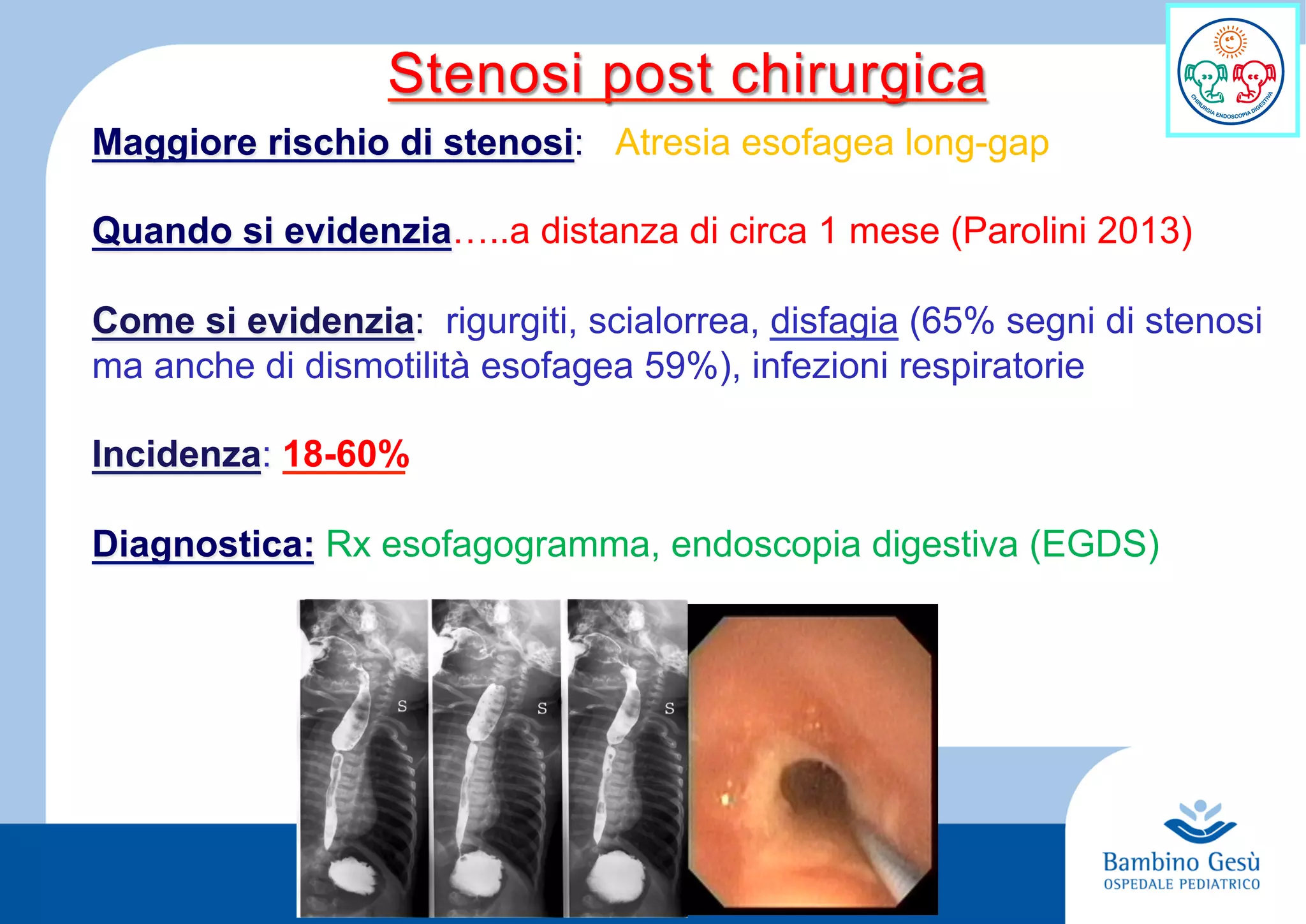 Atresia Esofagea - Stenosi e MRGE | PDF
