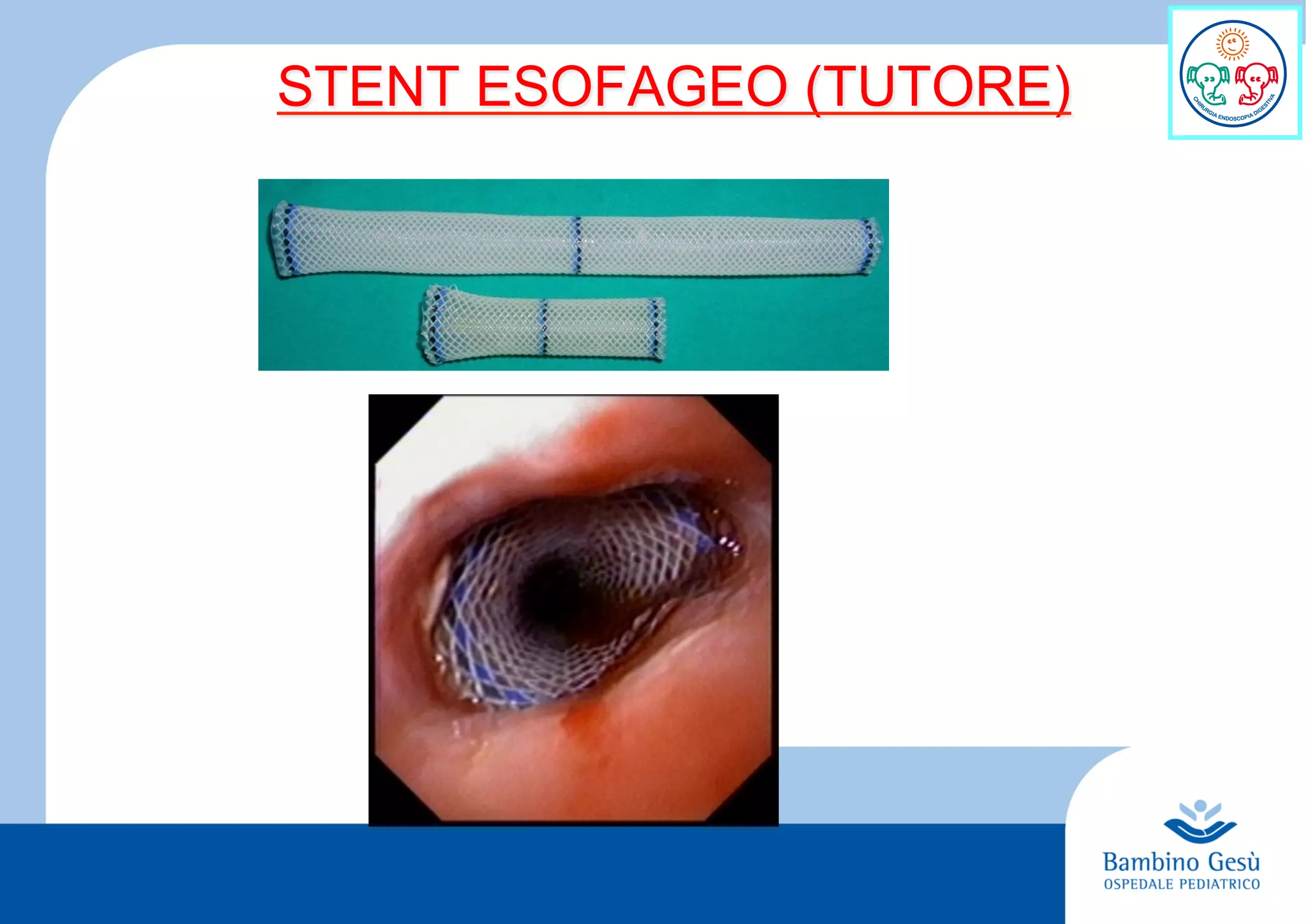 Atresia Esofagea - Stenosi e MRGE | PDF
