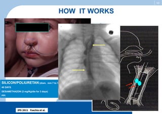 Atresia Esofagea - Stenosi e MRGE | PDF | Ear, Nose and Throat ...