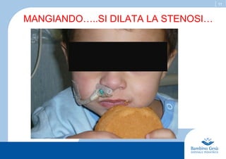 Atresia Esofagea - Stenosi e MRGE | PDF | Ear, Nose and Throat ...