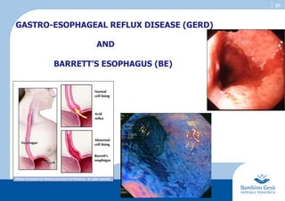 Atresia Esofagea - Stenosi e MRGE | PPT