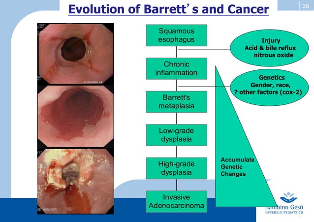 Atresia Esofagea - Stenosi e MRGE | PDF | Ear, Nose and Throat ...