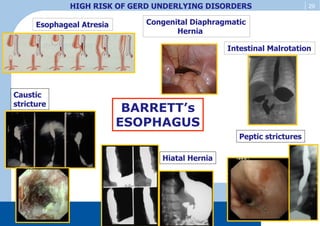 Atresia Esofagea - Stenosi e MRGE | PPT
