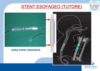 Atresia Esofagea - Stenosi e MRGE | PDF | Ear, Nose and Throat ...