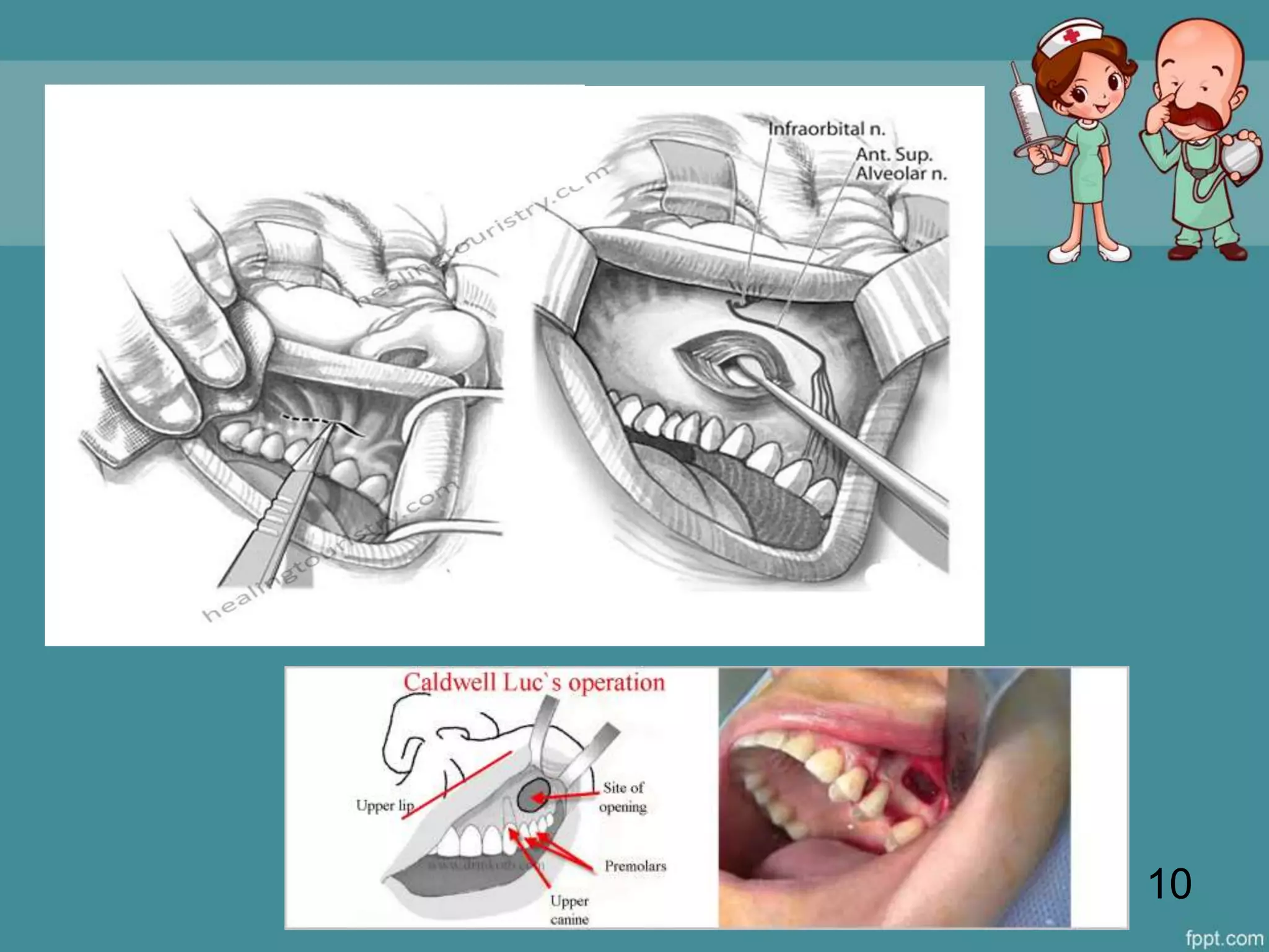 Caldwell luc surgery | PPT