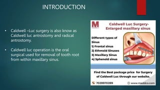 Caldwell Luc surgery.pptx