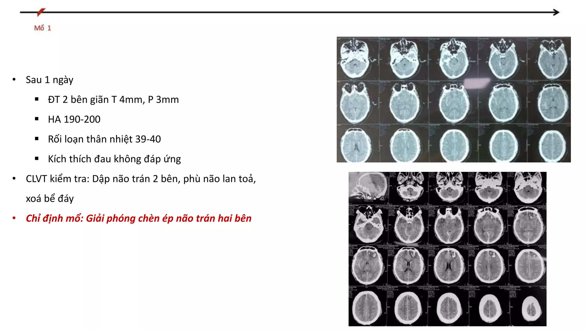 Ca LS CTSN nặng.pptx