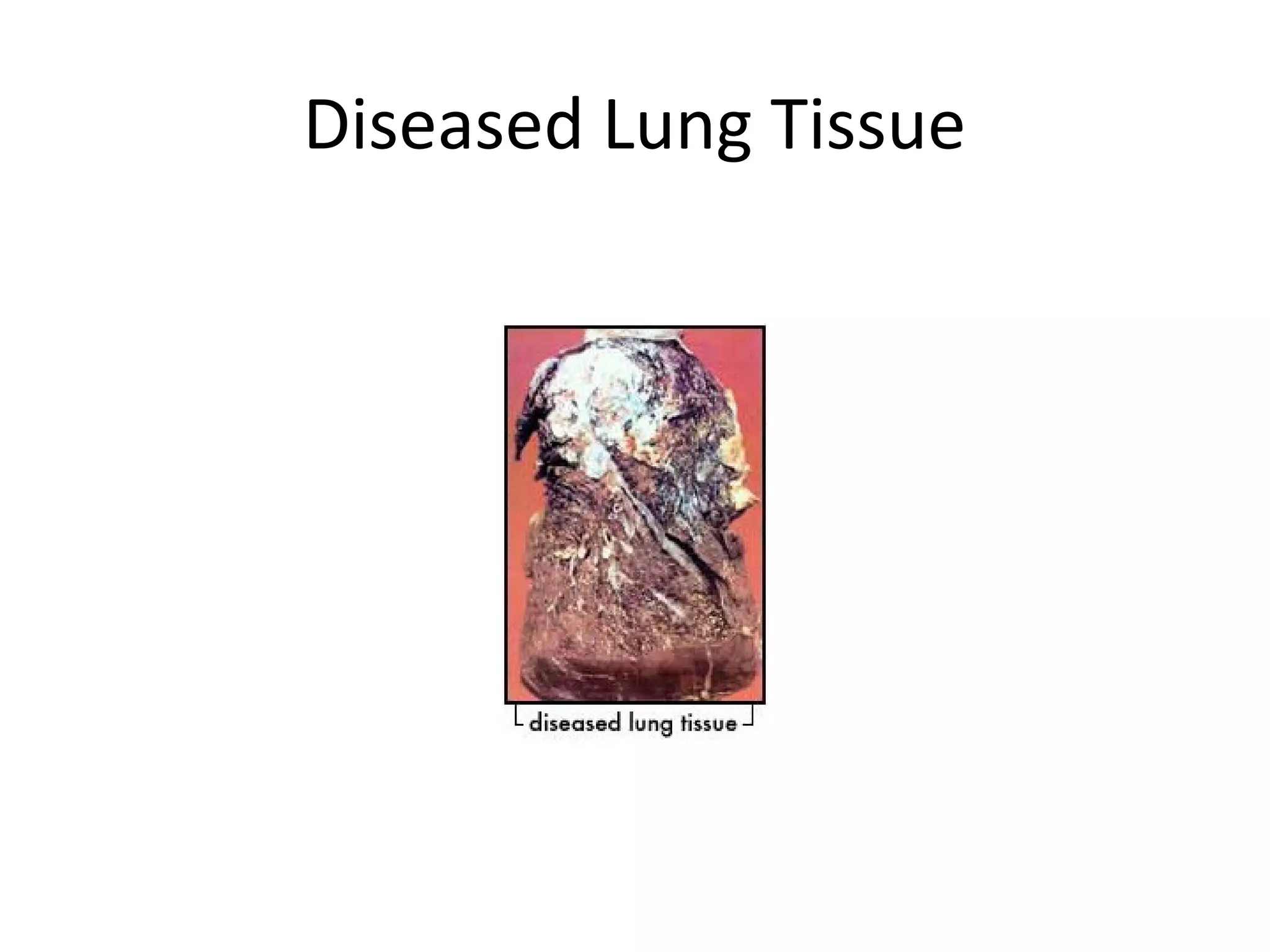Ca lung | PPT