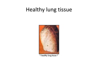 Ca lung | PPT