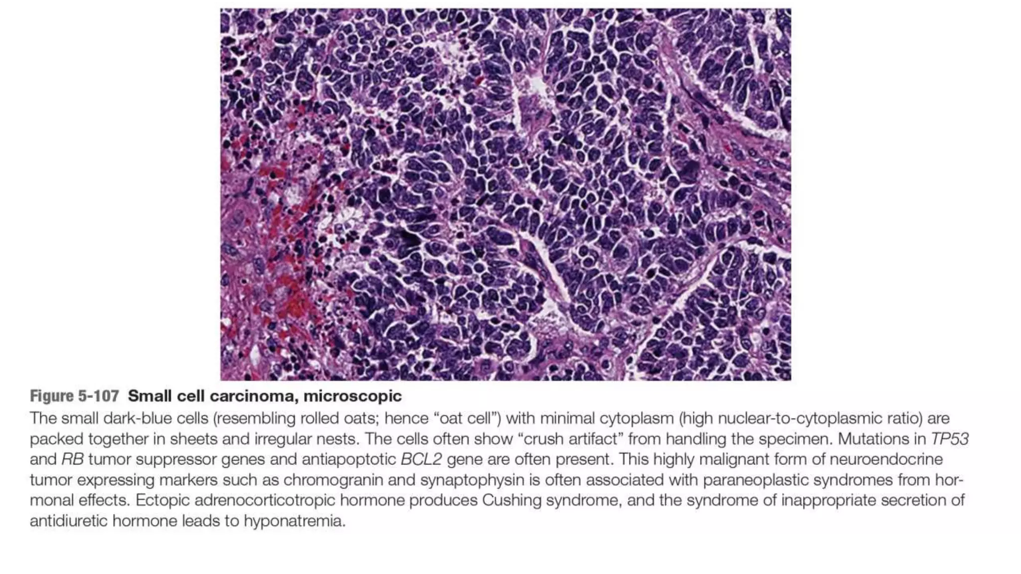 Ca lung | PPTX | Lung and Respiratory Health | Diseases and Conditions