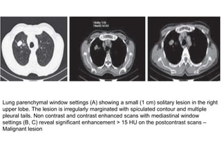 CT - Lung Carcinoma | PPTX