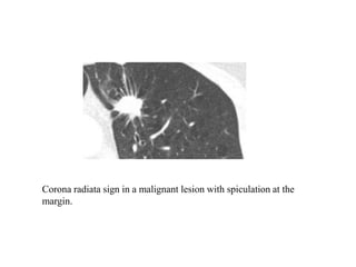 CT - Lung Carcinoma | PPTX
