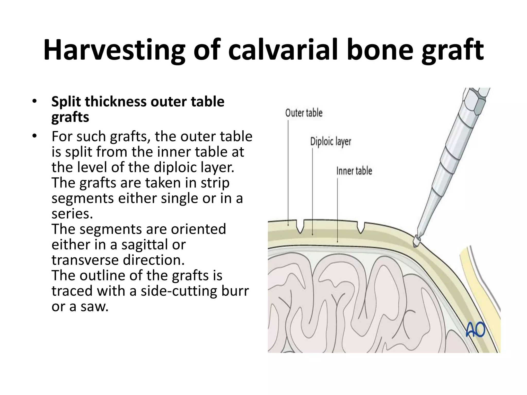 Calvarial bone graf harvesting | PPTX